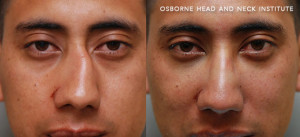 Broken Nose Treatment Los Angeles, CA