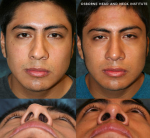 Broken Nose Treatment Los Angeles, CA