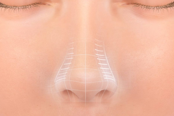 Functional Nasal Surgery Revision Rhinoplasty, Septal Perforation ...