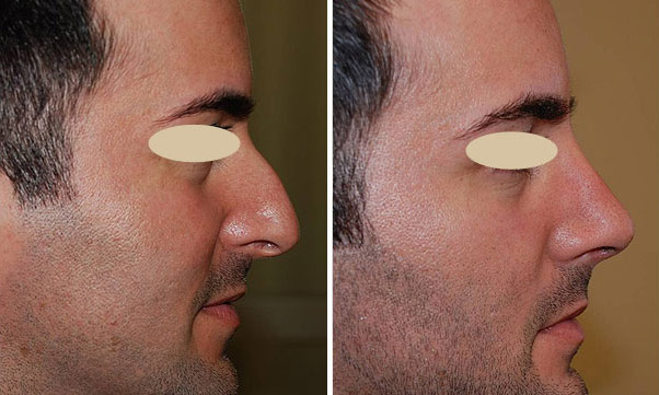 Functional Nasal Surgery Revision Rhinoplasty, Septal Perforation ...