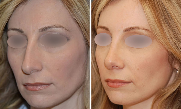 Functional Nasal Surgery Revision Rhinoplasty, Septal Perforation ...